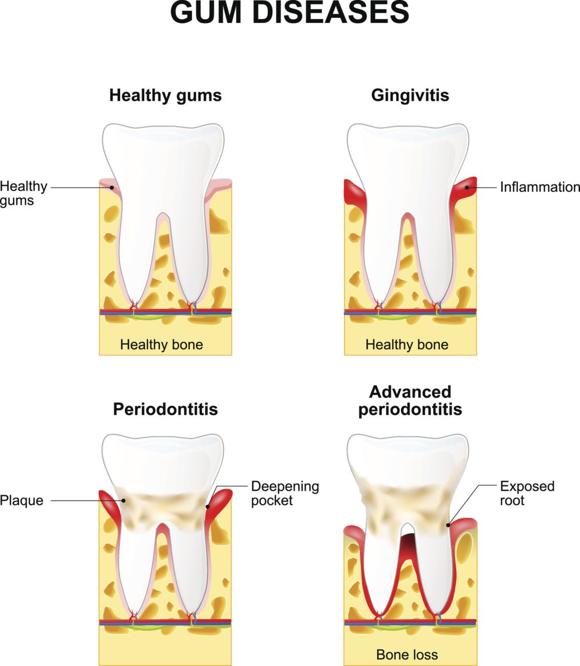 Bleeding Gums Treatment in Silver Spring MD