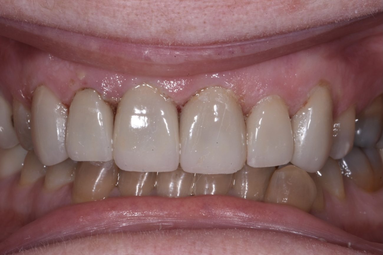 Silver Spring MD Cosmetic Dentistry Before & After Photos